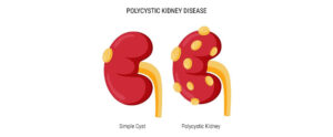 What Are Simple Kidney Cysts? | Clinical Renal Associates